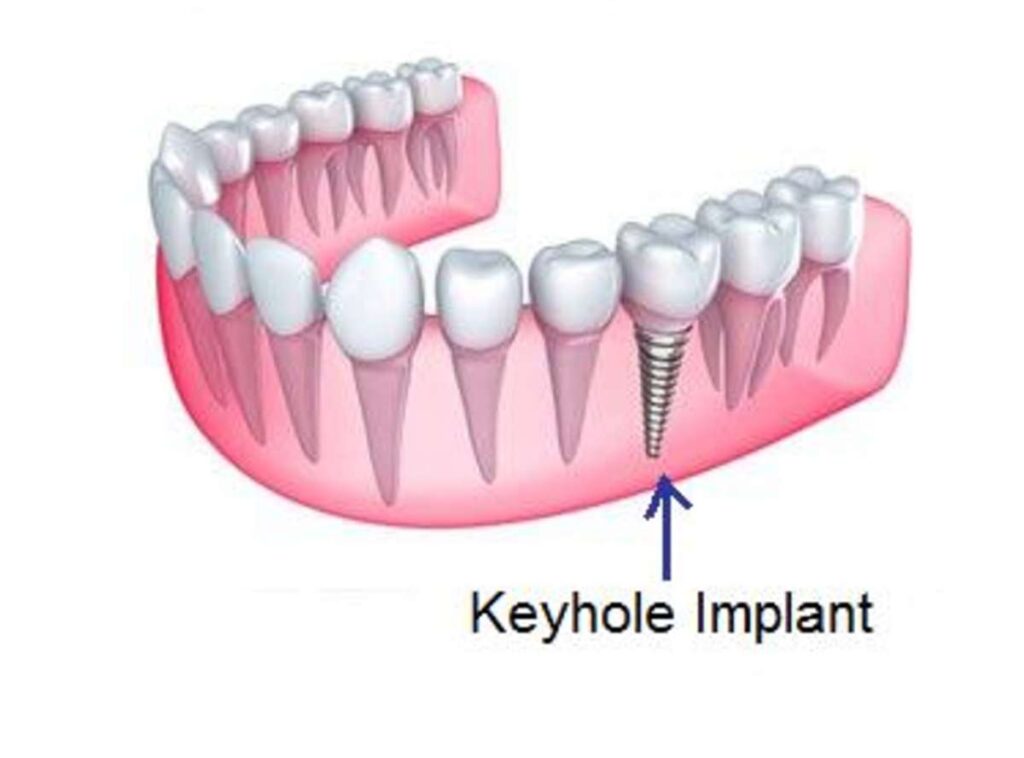 The keyhole approach offers several advantages over traditional implant ...